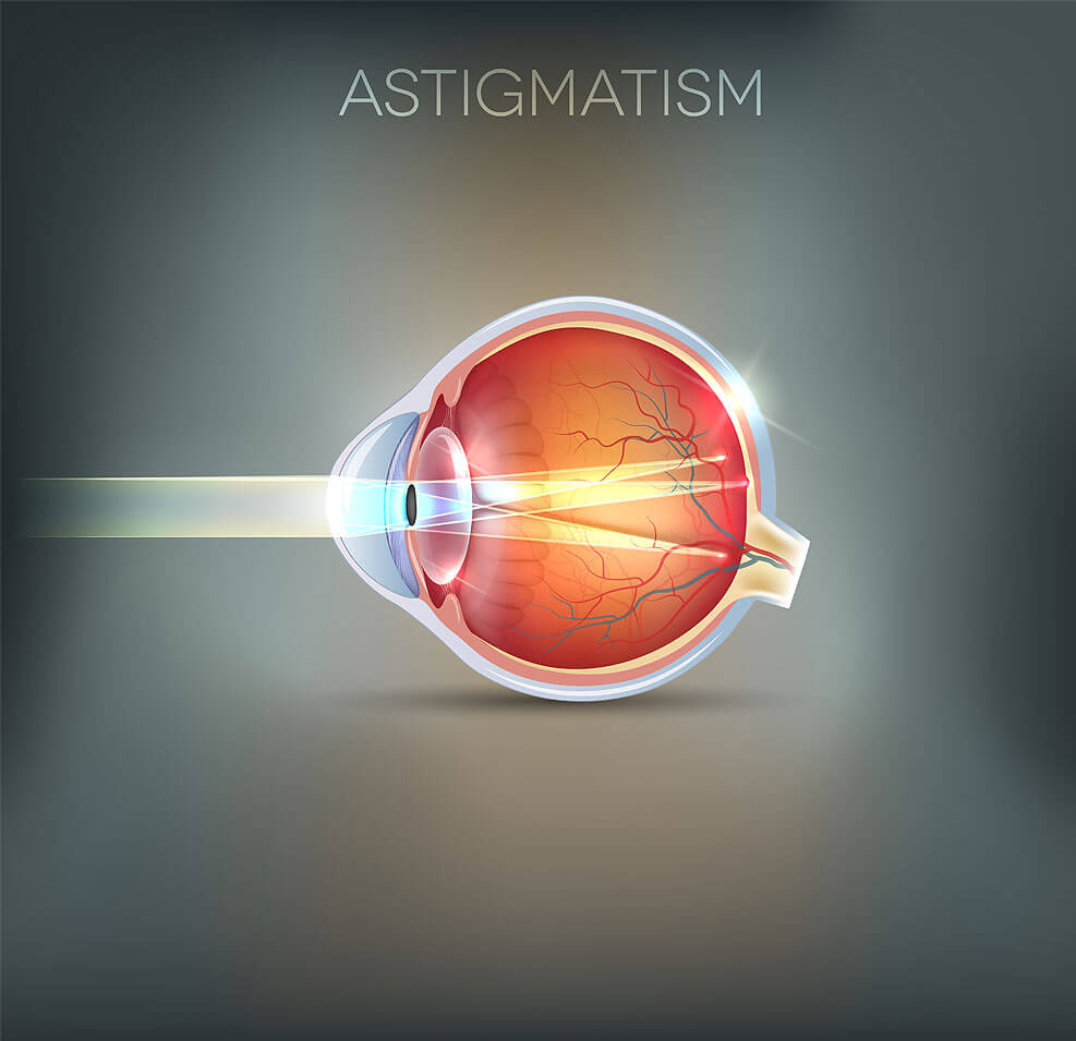 astigmatism - Anaheim Eye Institute